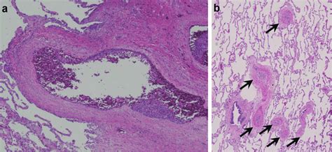 Patients Autopsy Findings Of The Lung Showing A Some Cancer Cells