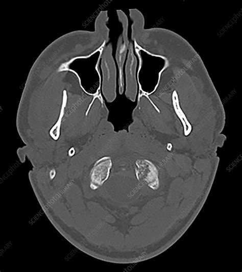 Occipital Condyle Fracture