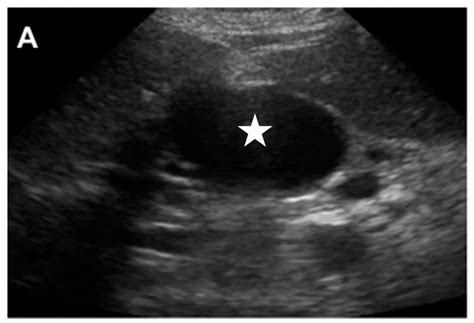 Gastrodoudenal Embolization Indications Technical Pearls And Outcomes