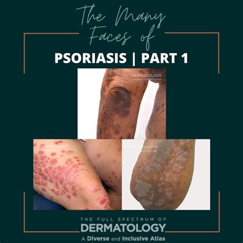 The Many Faces Of Psoriasis Part 1 Next Steps In Dermatology