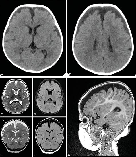 Hydrocephalus And Other Cerebrospinal Fluid Disorders Clinical Tree