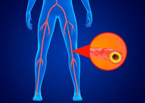 Peripheral Vascular Disease Pvd Symptoms Risks Treatment