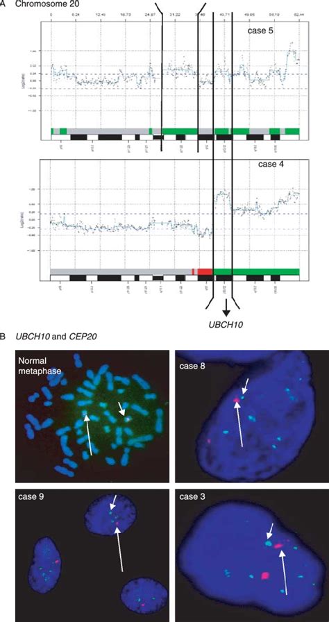 a array cgh profiles of chromosome 20 for case 5 upper showing