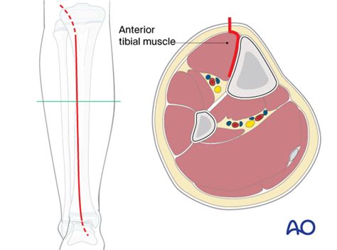Approach To The Anterolateral Tibial Surface