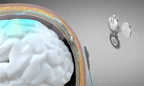 China Brain Computer Interface Implant Restored Patients Paralyzed Arm