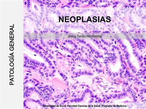 Neoplasias Pptx