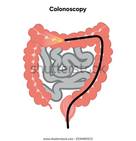 Colonoscopy Diagram Gastroscopy Endoscope Stock Vector Royalty Free 2534483515 Shutterstock