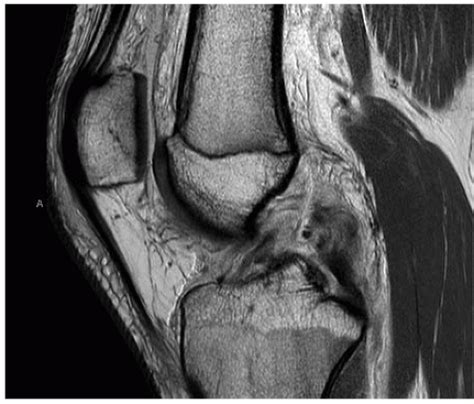 Arthroscopic Pcl Reconstruction Transtibial And Arthroscopic Inlay Techniques Musculoskeletal Key