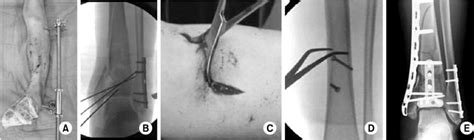 A Apply Femoral Distractor To Correct Axial Malalignment And To Download Scientific Diagram