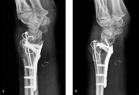 16 Radiocarpal Dislocation Musculoskeletal Key