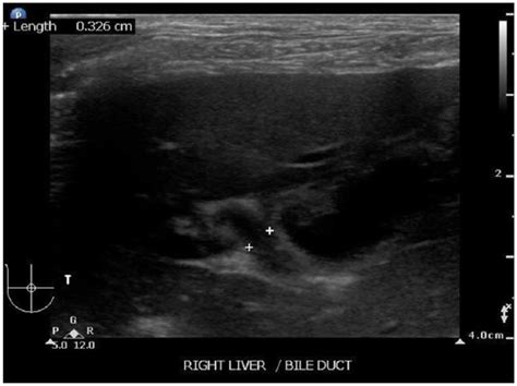 Successful Treatment Of Providencia Rettgeri Cholecystitis And Neutrophilic Cholangitis In A Cat