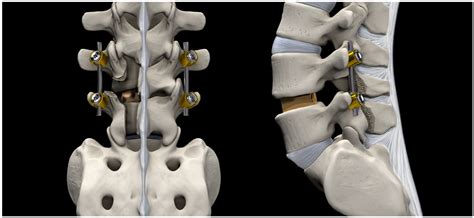 Lumbar Spine Surgery