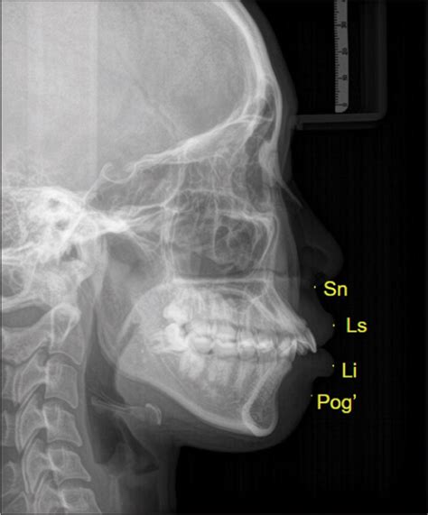 Effects Of Mini Implant Anchorage On Mandibular Rotation And Esthetic