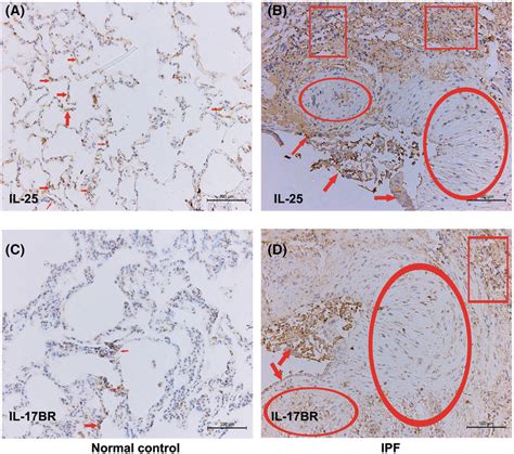 Expression Levels Of Il‐25 Il‐17br In Ipf Lungs Shown Is Download
