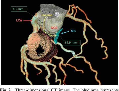 Figure 2 From Aortic Annular Enlargement With Modified Y Incision Technique Devised From