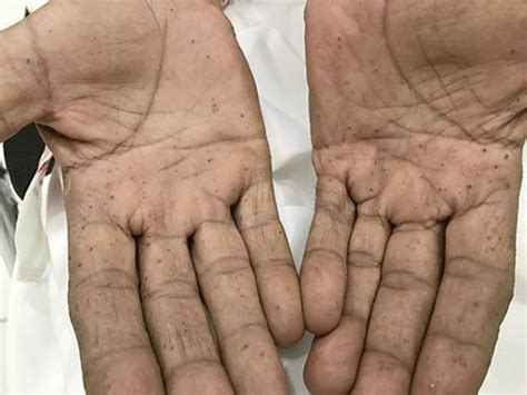 Punctate Palmoplantar Keratoderma A Case Report Of Type 1 Buschke Fischer Brauer Disease Punctate Palmoplantar Keratoderma A Case Report Of Type 1 Buschke Fischer Brauer Disease
