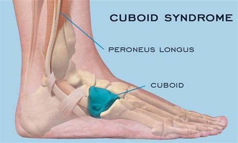 Cuboid Syndrome Universal City Tx And Pleasanton Tx Next Step Foot