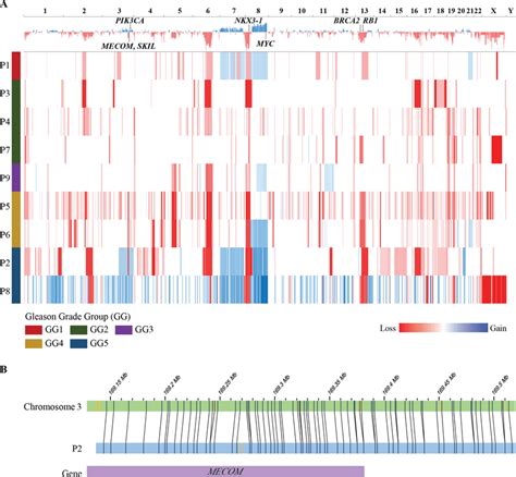 Copy Number Variations Of Prostate Cancer Tissue Sample A Copy Number Download Scientific