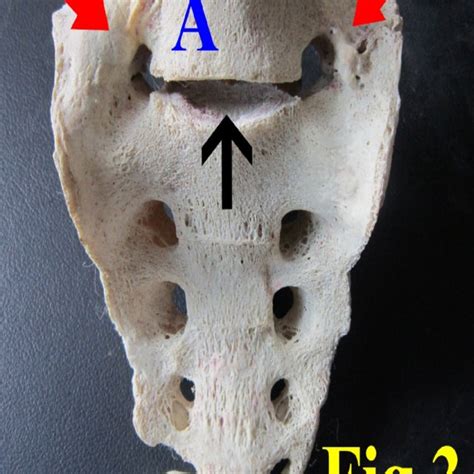 Showing Unilateral Sacralization A 5 Th Lumbar Vertebra Red Colour
