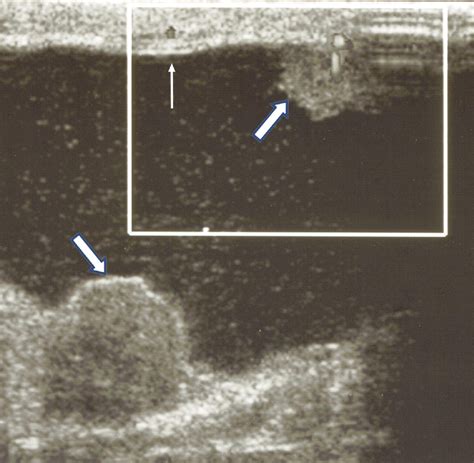 Preoperative Diagnosis Of Malignant Mesothelioma Of The Tunica