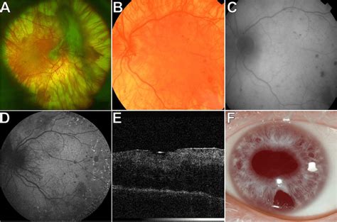 Oculocutaneous Albinism 1