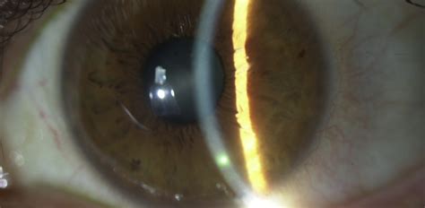 Hard Contact Lenses Corneal Edema At Michael Oglesby Blog