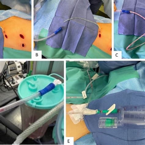 Photographs Showing The Management Of The Drain During Wound Closure Download Scientific