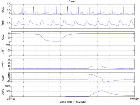 Case 1 Waveform Plots 10 Second Plots