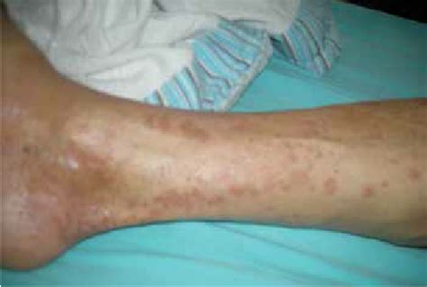 Purpuric Skin Eruptions Due To Leucocytoclastic Vasculitis Download Scientific Diagram