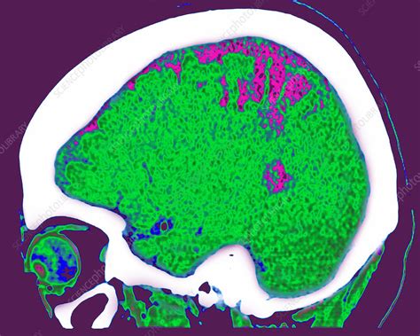 Cerebral Atrophy Ct Scan Stock Image C025 4464 Science Photo Library