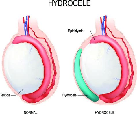 Hydrocele Removal Surgery