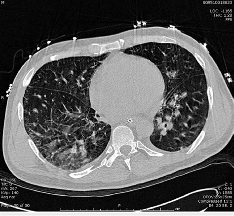 Patchy Pulmonary Noninfectious Infiltrates Download Scientific Diagram Patchy Pulmonary Noninfectious Infiltrates Download Scientific Diagram