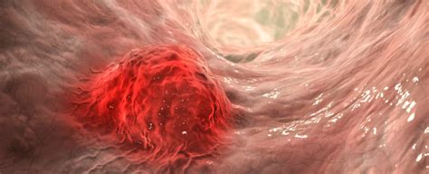 Common Forever Chemicals May Trigger Cancer Cells To Spread General News Nsane Forums