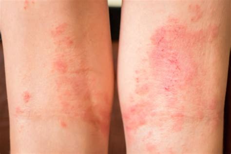Dermatitis Atópica Qué Es Y Cómo Tratarla La Tercera