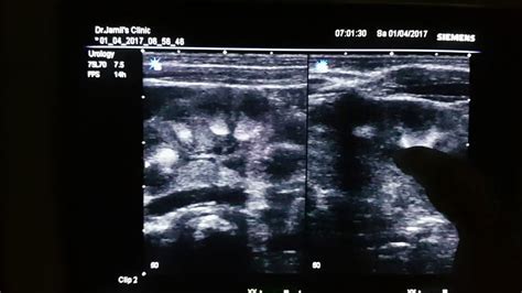 Medullary Nephrocalcinosis Ultrasound Youtube