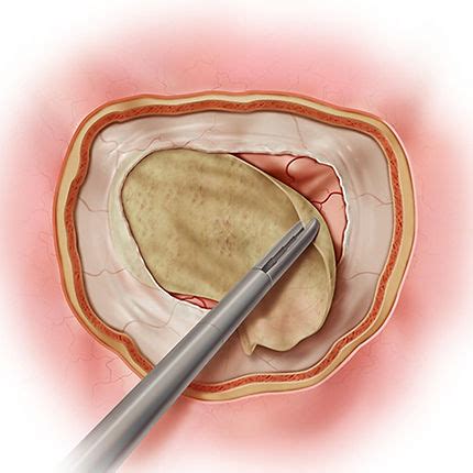 Everis Duraplasty Surgipa Medical