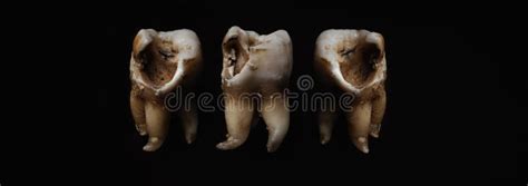 Macro Shot Of A Decayed Teeth Till Root After Extraction Of Dentist