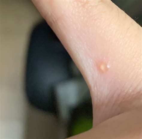 이게뭔가요 손에 투명한물집 수족구 무좀 지식in