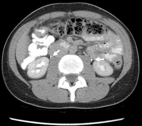 Delayed Imaging To Visualize Ureteral Jets Journal Of Gynecologic Surgery