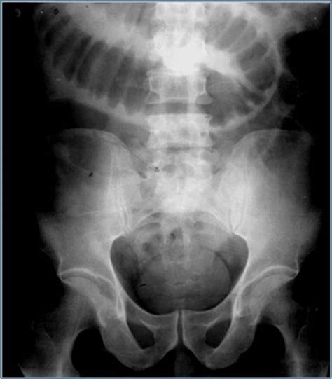 Small Bowel Jejunal Ischemia Radrounds Radiology Network