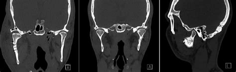 Ct Scan Samples For Orif Operation Left Early Postoperative Scan
