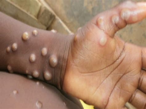 सकसअल एकटवट क वजह स फल रह ह मकपकस सकरमण रसरच म पए गए नए लकषण Monkeypox