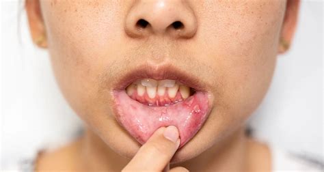 Canker Sores Causes And Ways To Prevent Them