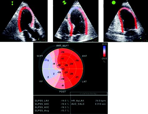 Global Longitudinal Strain Predicts Long Term Survival In Patients With