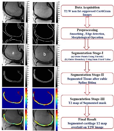figure 1 from automated segmentation of knee cartilage using modified