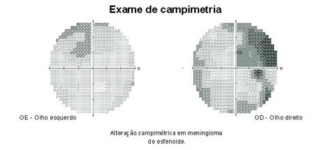 Campimetria Exame De Campo Visual Ou Perimetria Ocular