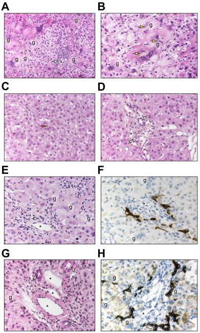 Aagenaes Syndrome Lymphedema Cholestasis Syndrome 1 Is Caused By A
