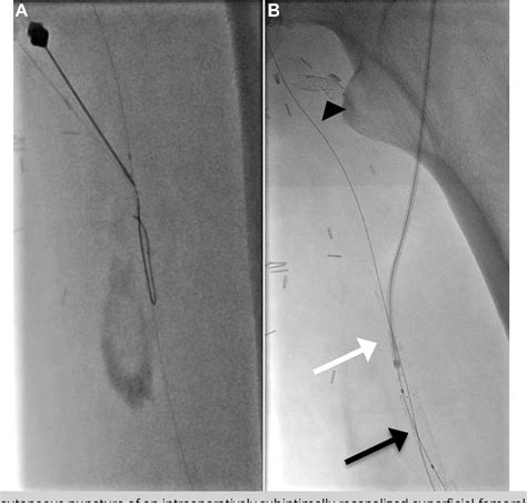 Percutaneous Access Of An Intraoperatively Recanalized Mid Superficial