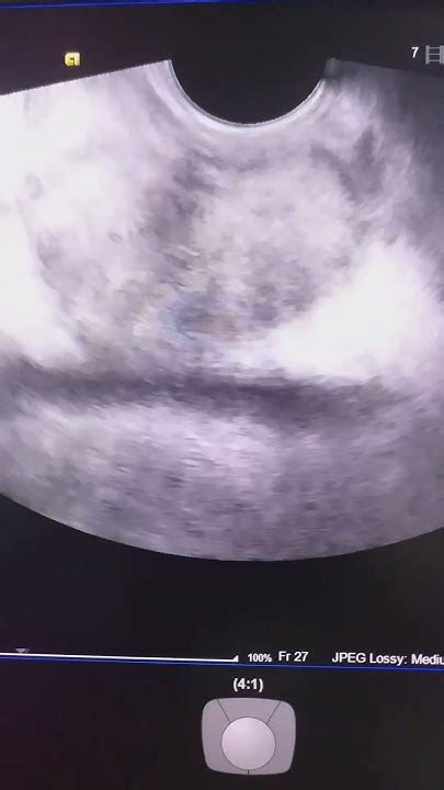 узд простата ДГПЗ Youtube