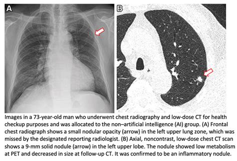 ai improves detection of lung nodules on chest x ray applied radiology